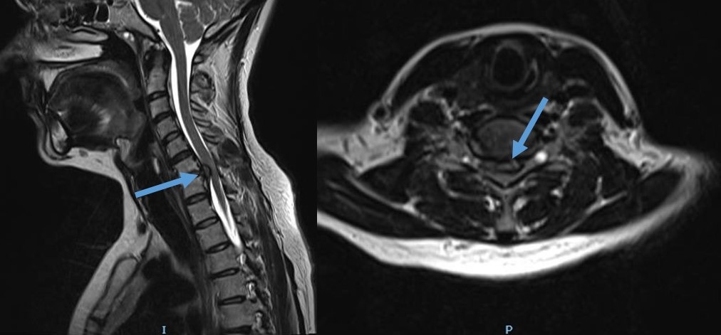 Hernia discal cervical – Neurocirugía en Almería
